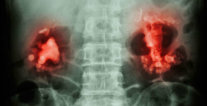 Urolithiasis - Uroweb