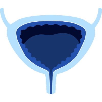 Muscle-invasive bladder cancer - Patient Information