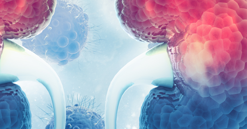 Urolithiasis - Uroweb