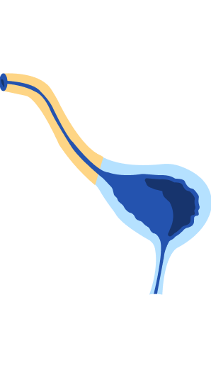 Urachal cancer - Patient Information